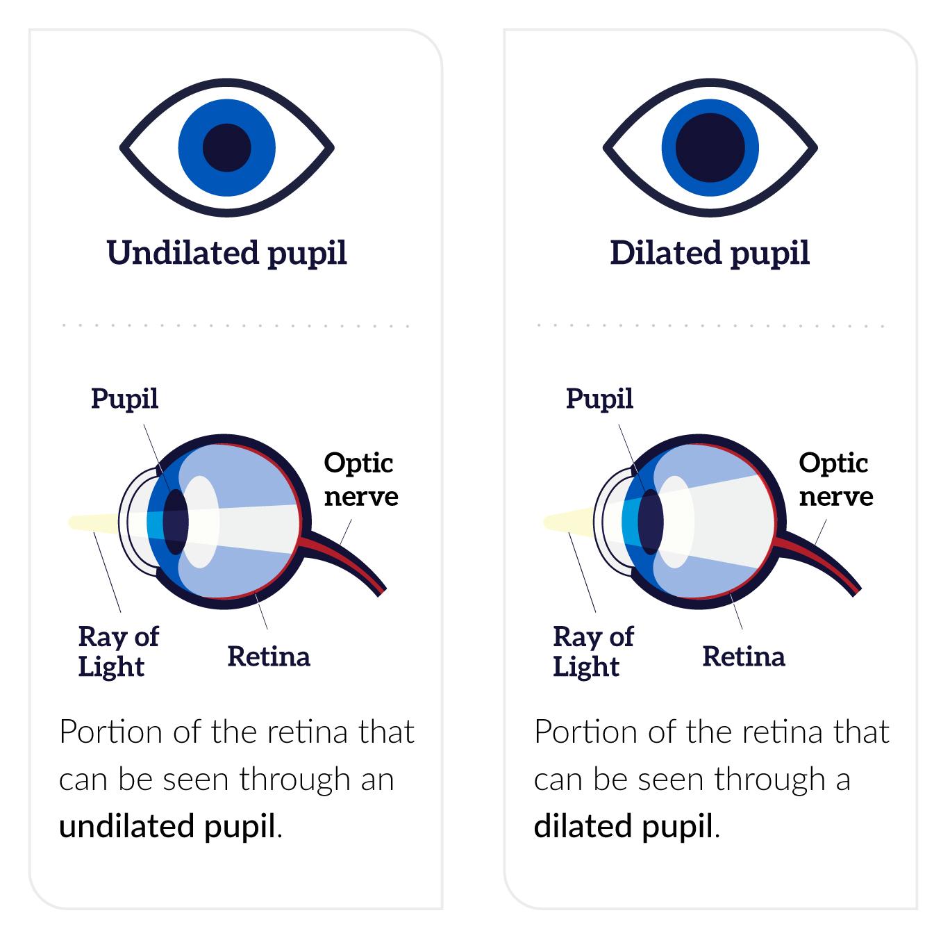 Dilated vs. Undilated Refraction: – Gupta Eye Care Bhiwadi